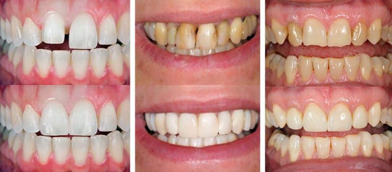 Veneers Düsseldorf - Schöne Zähne mit Veneersbehandlung