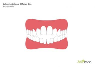 Häufige Zahnfehlstellungen | Behandlung, Dauer, Kosten | 360°zahn ...