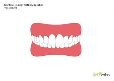 Häufige Zahnfehlstellungen | Behandlung, Dauer, Kosten | 360°zahn ...