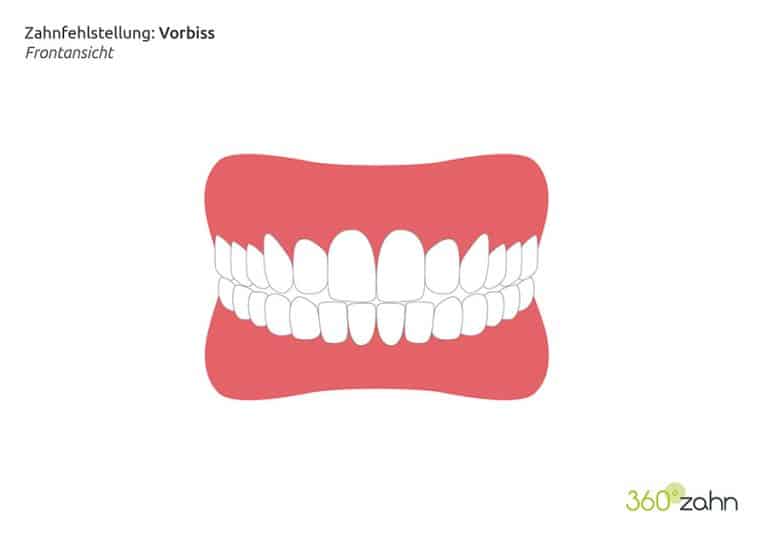 Häufige Zahnfehlstellungen | Behandlung, Dauer, Kosten | 360°zahn ...