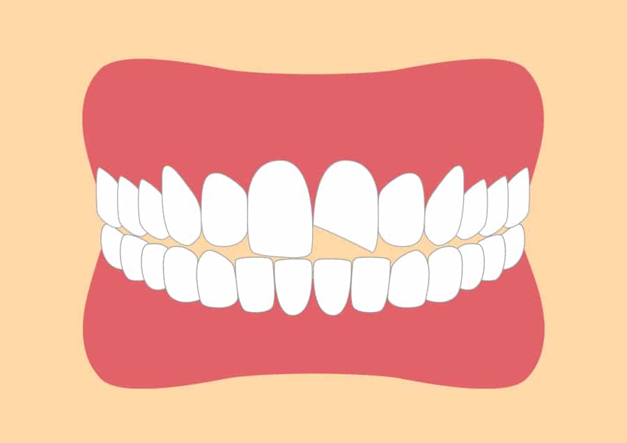 Ihr Zahn ist abgebrochen? Das sollten Sie tun! - 360°zahn