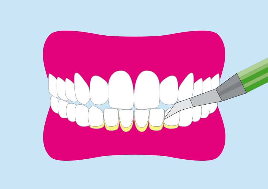 Zahnstein entfernen | Zahnsteinentfernung | 360°zahn Düsseldorf